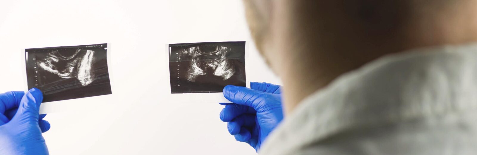 Medicare Prostate Biopsy and Cancer Screening Coverage | GoHealth